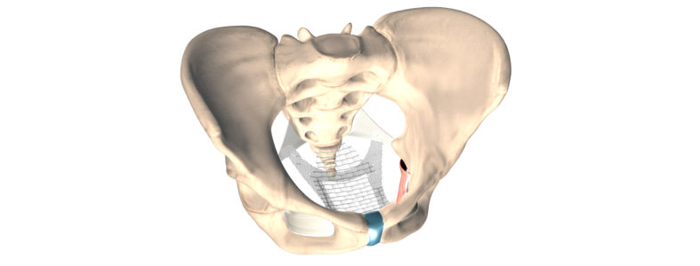 Лечение пролапса тазовых органов на поздней стадии